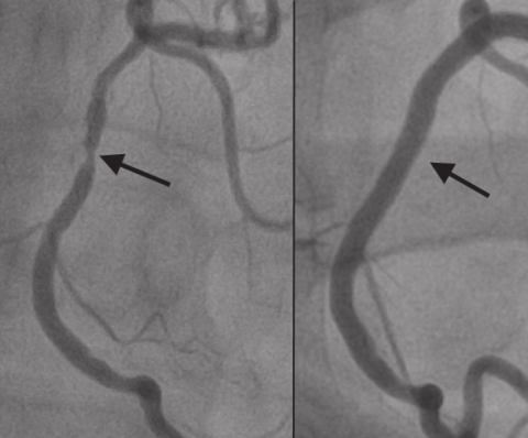 PCI Percutaneous Coronary Intervention | Dr Mark Appleby